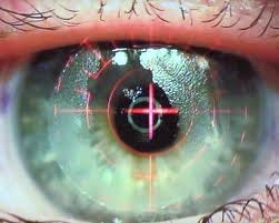 LASIK Destroyed My Eyes! – Praharsha Mulpur – Medium